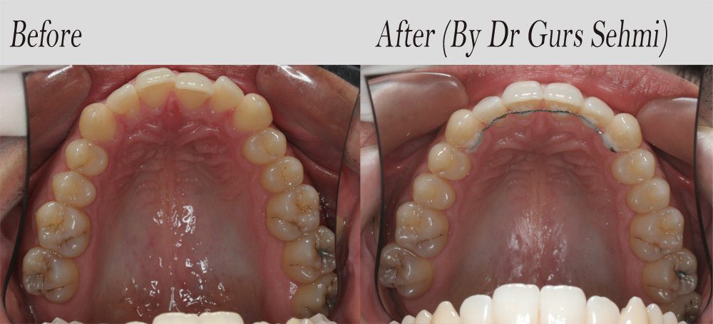 upper-teeth-braces - Dr Gurs Sehmi