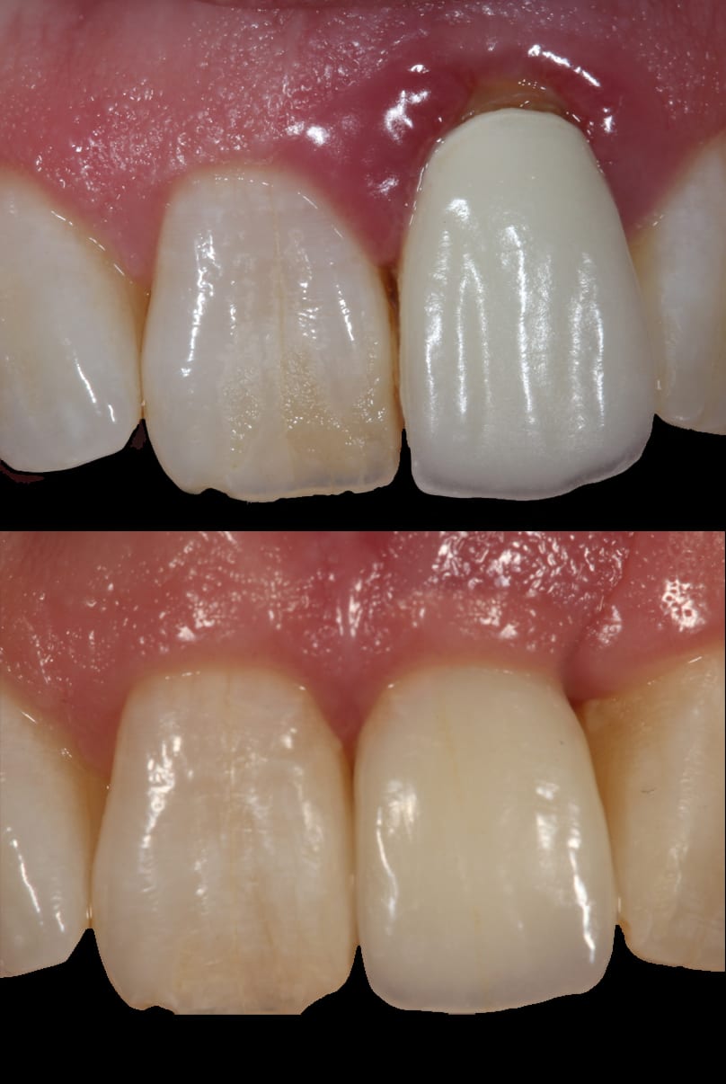 Before After CD Implant Front port - Dr Gurs Sehmi