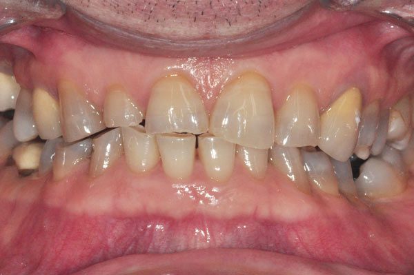 heavy-tooth-wear-treated-with-emax-porcelain-crowns-dental ...