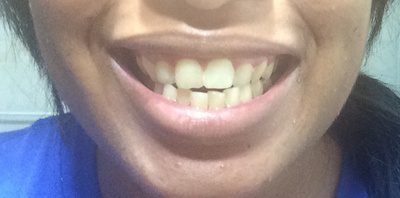 One of my front teeth is uneven and moving forward, what can I do? - Dr ...