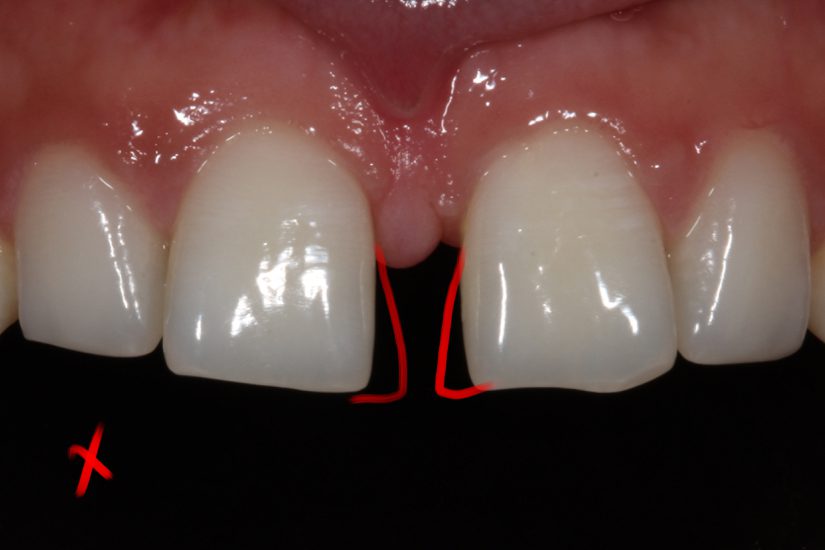 Tips on Reducing a Dental Diastema - Dr Gurs Sehmi