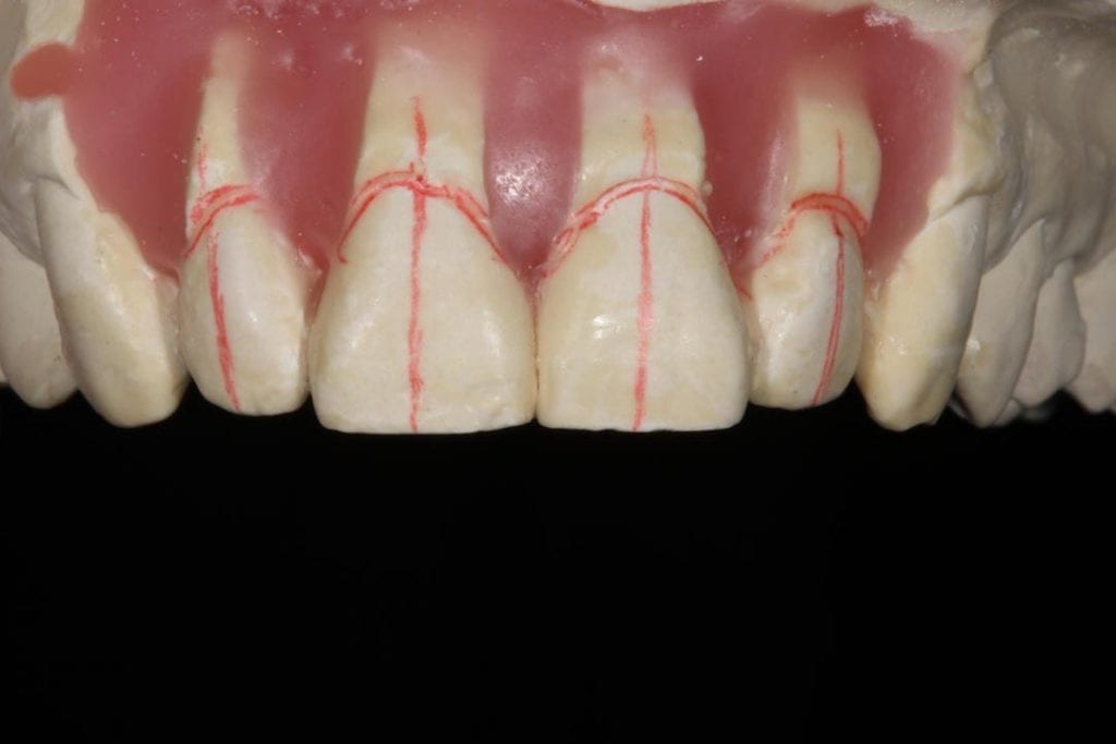 A Simple Class 2 Div 2 with a sectional lingual brace - Dr Gurs Sehmi