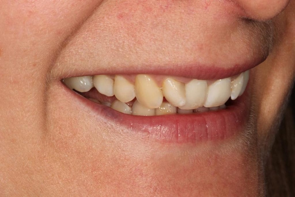 A Simple Class 2 Div 2 with a sectional lingual brace - Dr Gurs Sehmi