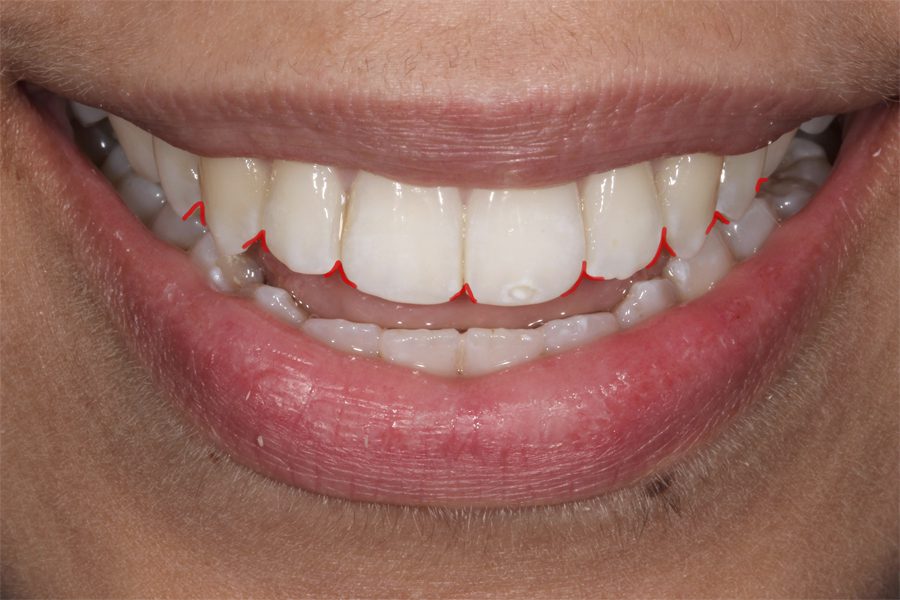 The embrasure is the amount of curvature at the corners of the teeth ...