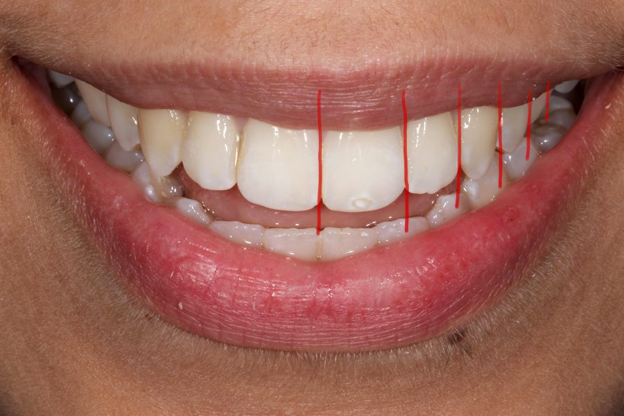 The teeth should reduce by a specific proportion, this is known as the ...