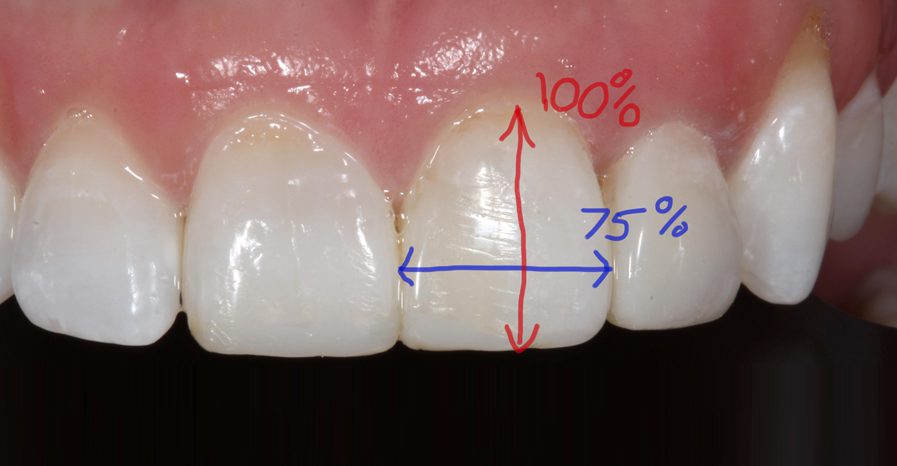 The width of your front teeth should be about 75-80% of the height ...