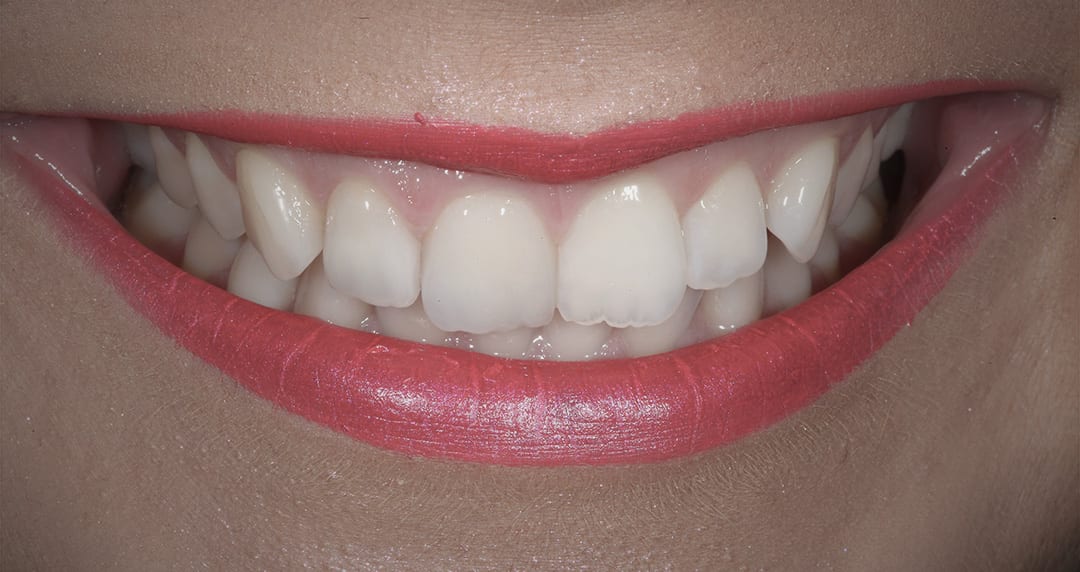 Smile Design - Dr Gurs Sehmi