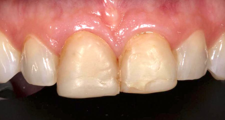 A Brand New Smile with Composite Veneers - Dr Gurs Sehmi