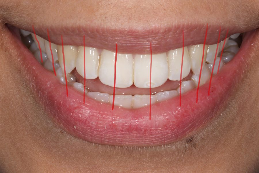 A line angle is where the front of the tooth starts to curve, and ...