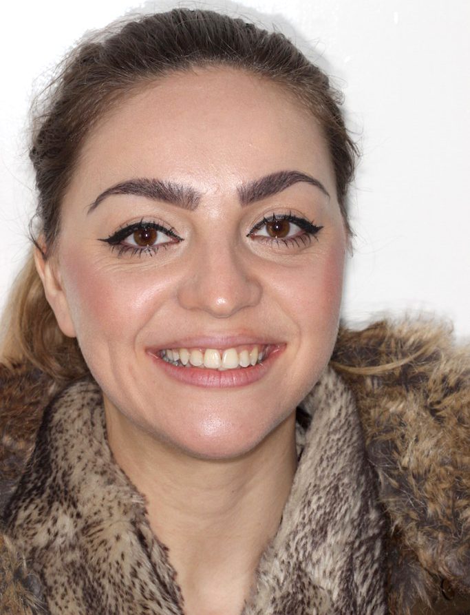Emily - Making a big front tooth look smaller - Dr Gurs Sehmi