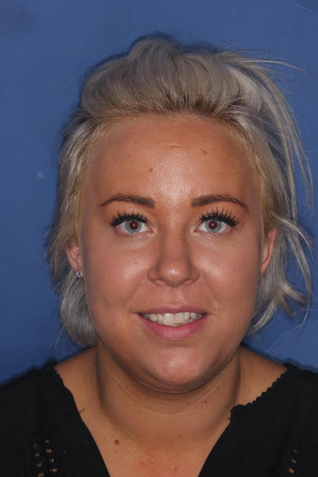 Emily - Making a big front tooth look smaller - Dr Gurs Sehmi