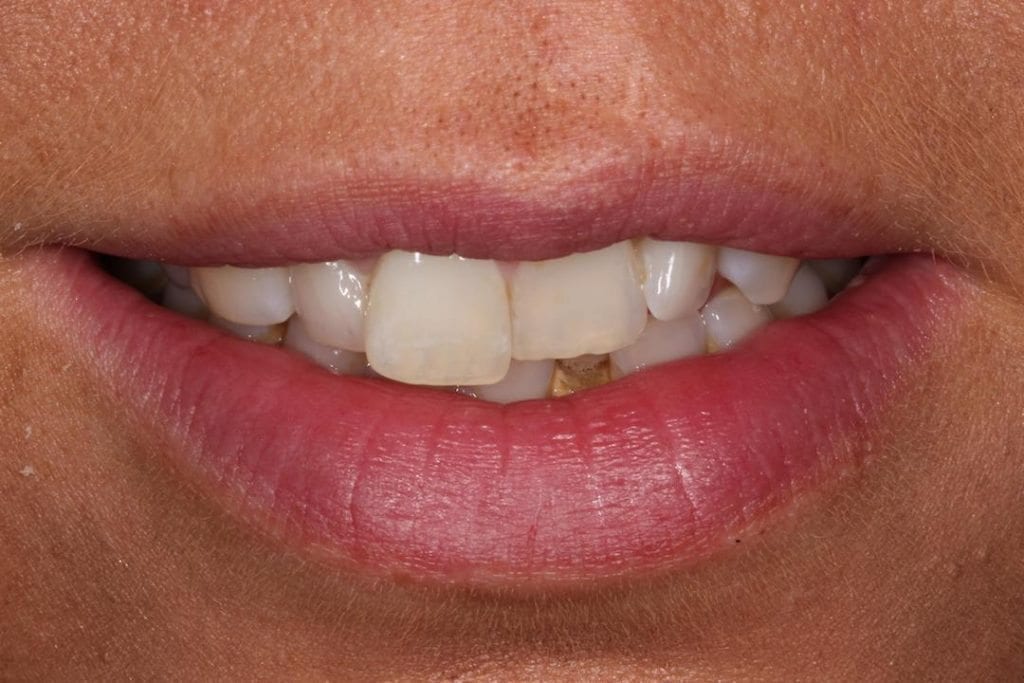 Emily - Making a big front tooth look smaller - Dr Gurs Sehmi