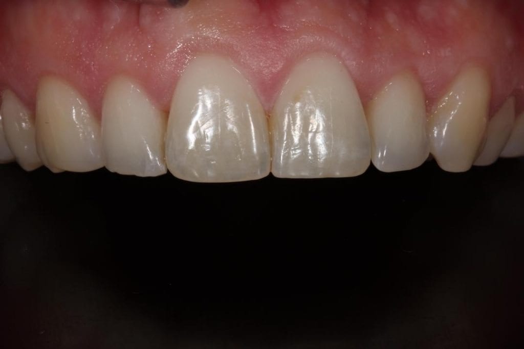 Emily - Making a big front tooth look smaller - Dr Gurs Sehmi