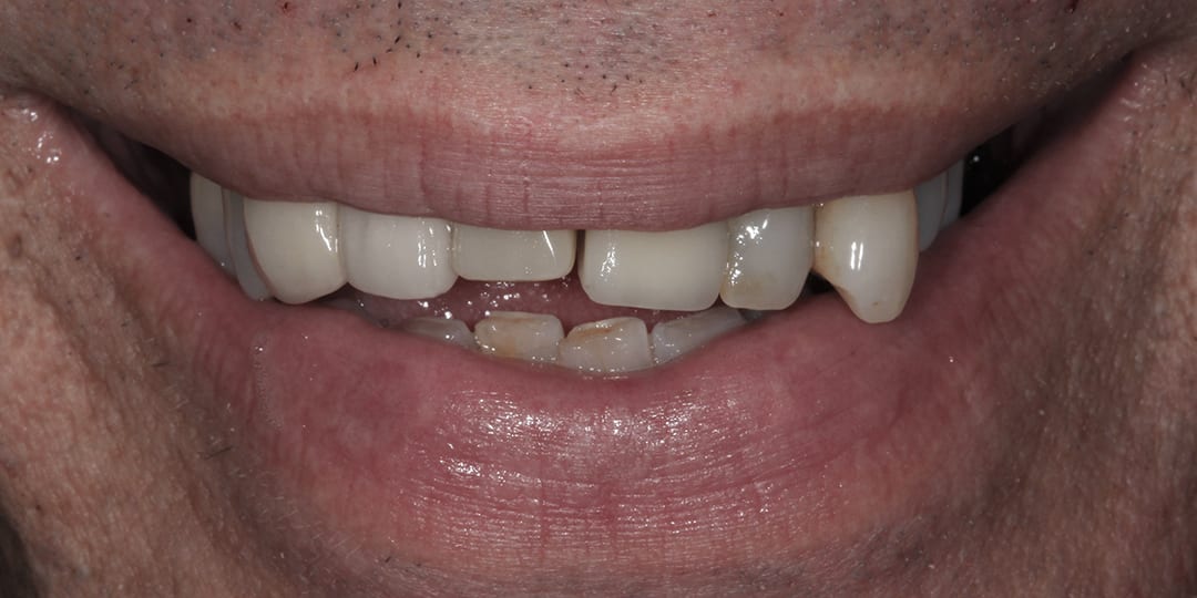 New Front Teeth To Throw Away Denture - Dr Gurs Sehmi
