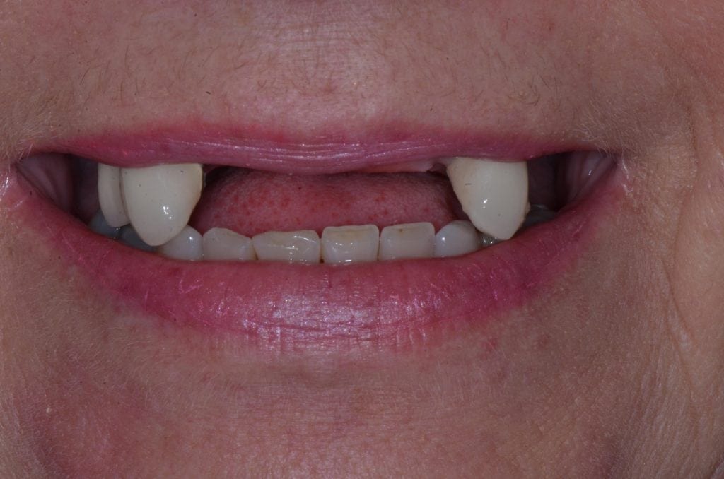 Full set of top teeth on Dental Implants - Dr Gurs Sehmi
