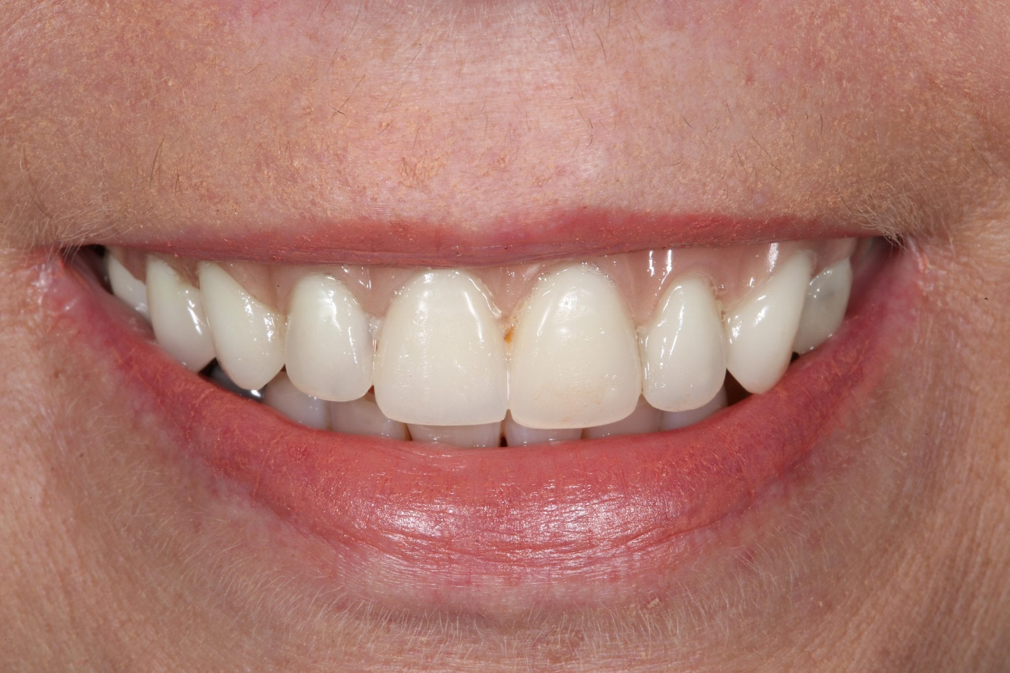 Full set of top teeth on Dental Implants - Dr Gurs Sehmi