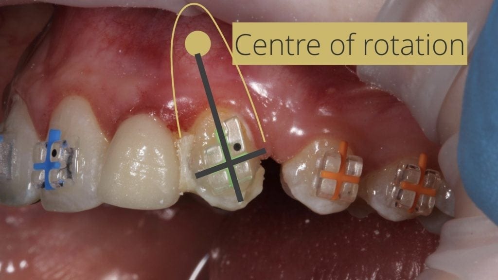 Aligning teeth with braces to make space for dental implants - Dr Gurs ...