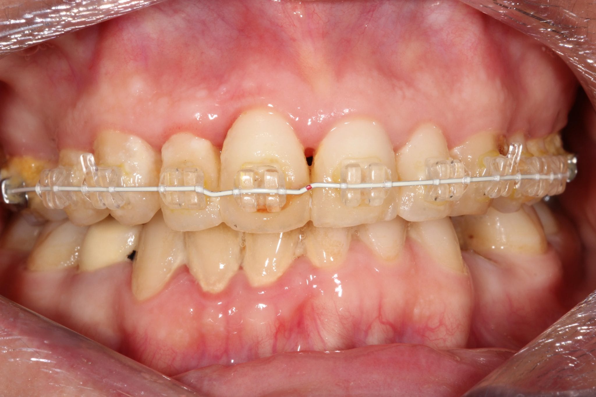 Introduction in to wire bending to finish orthodontic cases - Dr Gurs Sehmi