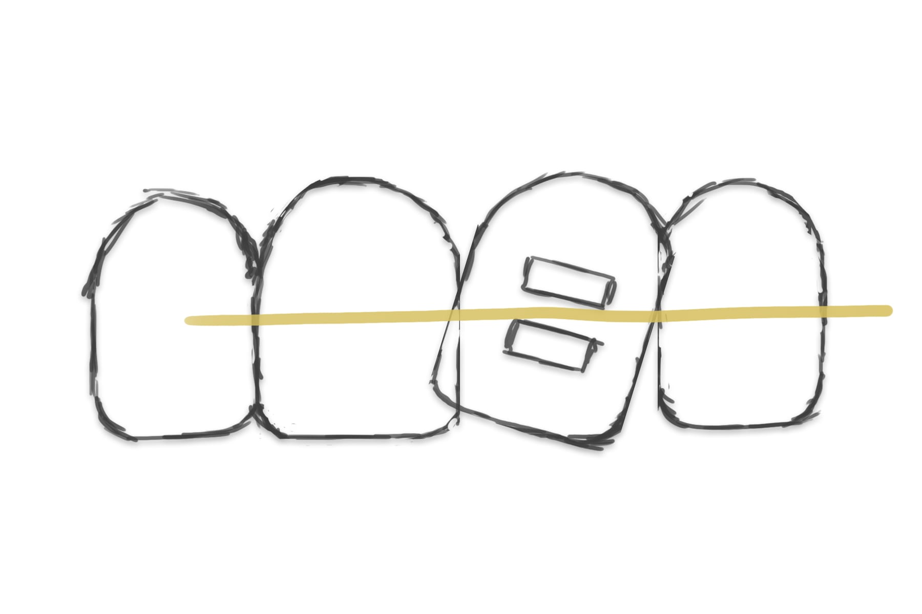 Introduction in to wire bending to finish orthodontic cases - Dr Gurs Sehmi