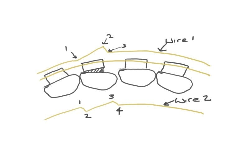 Introduction in to wire bending to finish orthodontic cases - Dr Gurs Sehmi