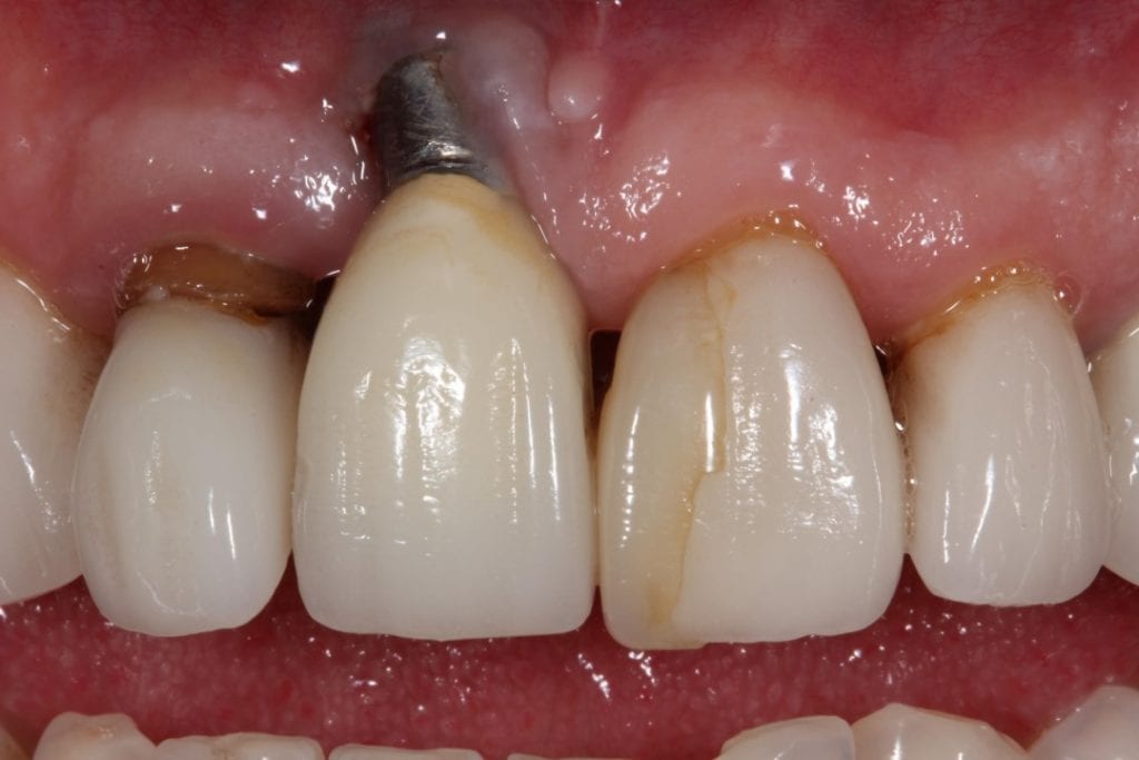 Metal showing on a dental implant - one possible solution - Dr Gurs Sehmi