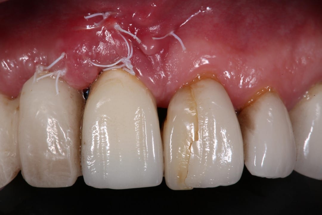 Metal showing on a dental implant - one possible solution - Dr Gurs Sehmi