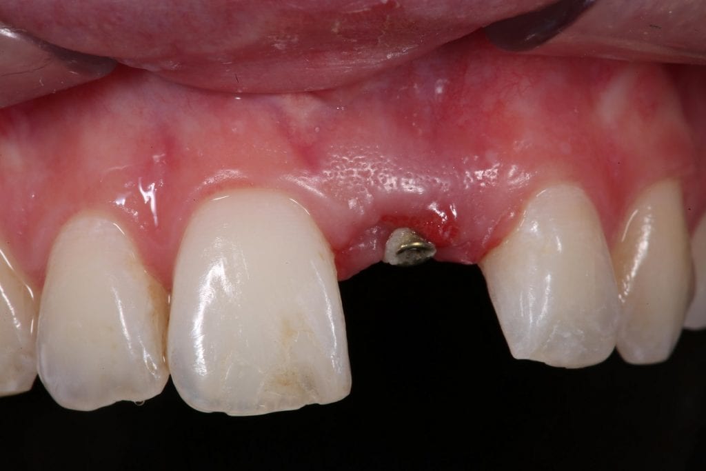 How to replace a front tooth with a dental implant and make it look ...