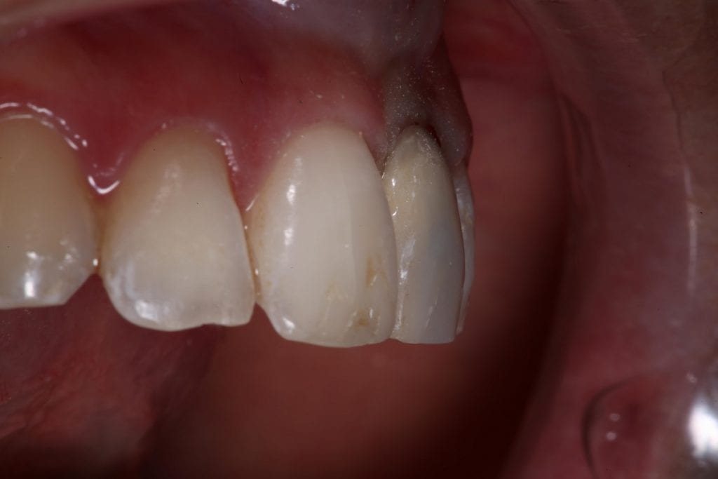 How to replace a front tooth with a dental implant and make it look ...