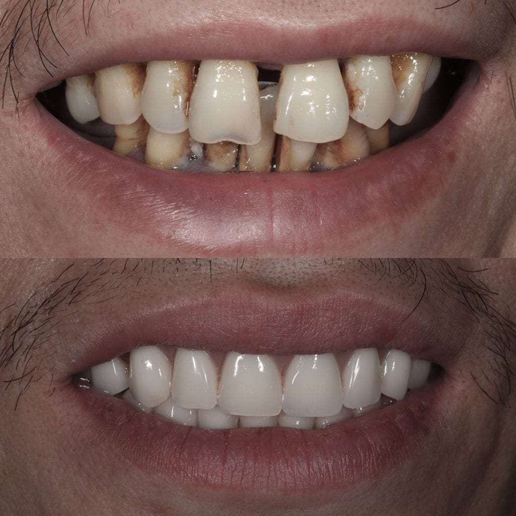 Dental Implants London From Dr Gurs Sehmi Cosmetic Dentist London