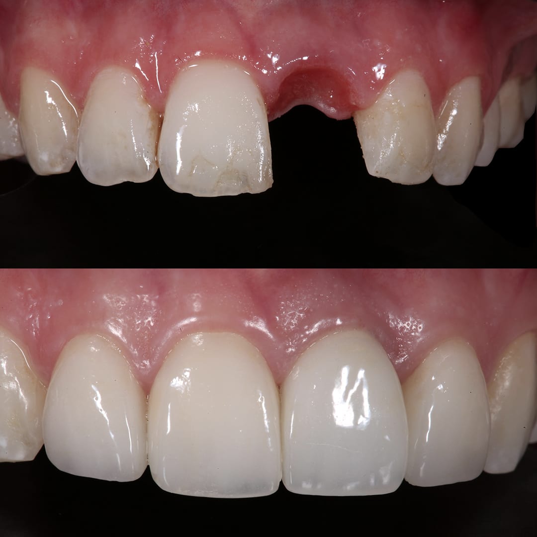 Single Front Denture Treatment London