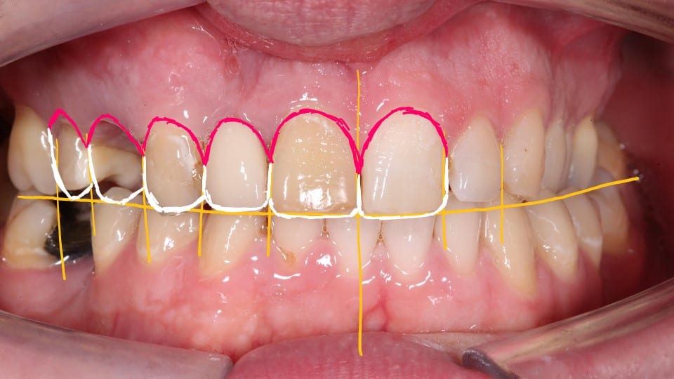 Smile design - How to get perfect temporaries - Dr Gurs Sehmi