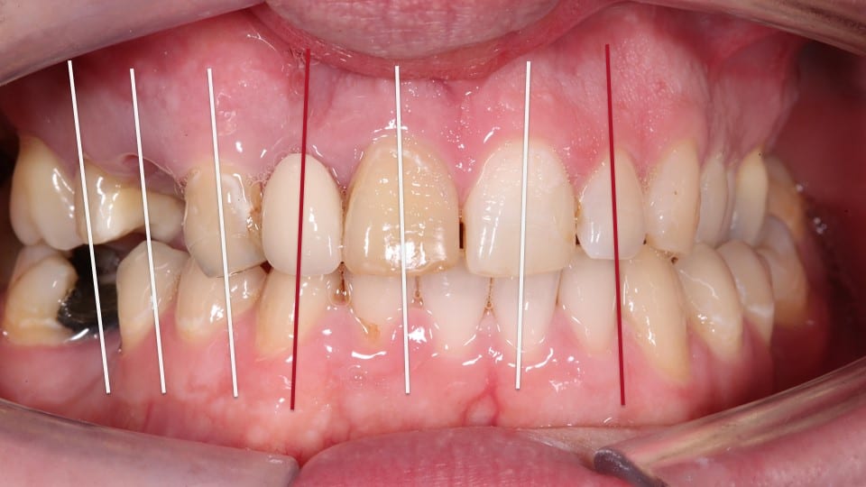 Smile makeover- Missing and discoloured teeth - Dr Gurs Sehmi