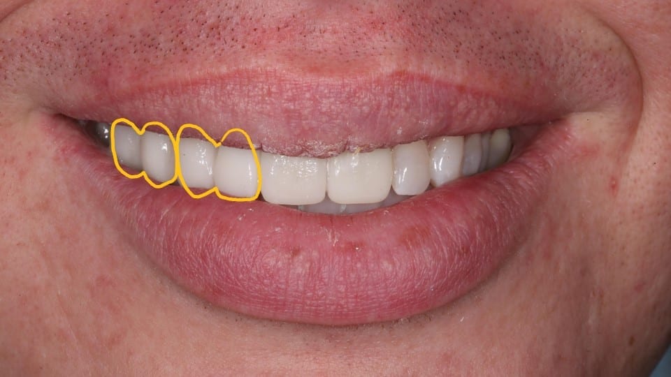 Smile makeover- Missing and discoloured teeth - Dr Gurs Sehmi