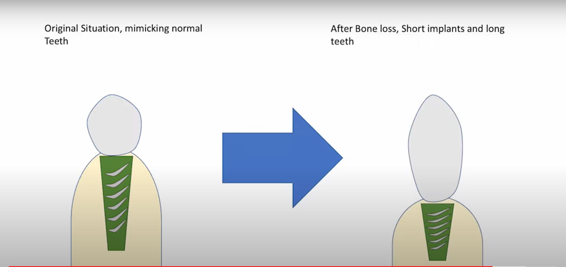 long tooth - Dr Gurs Sehmi