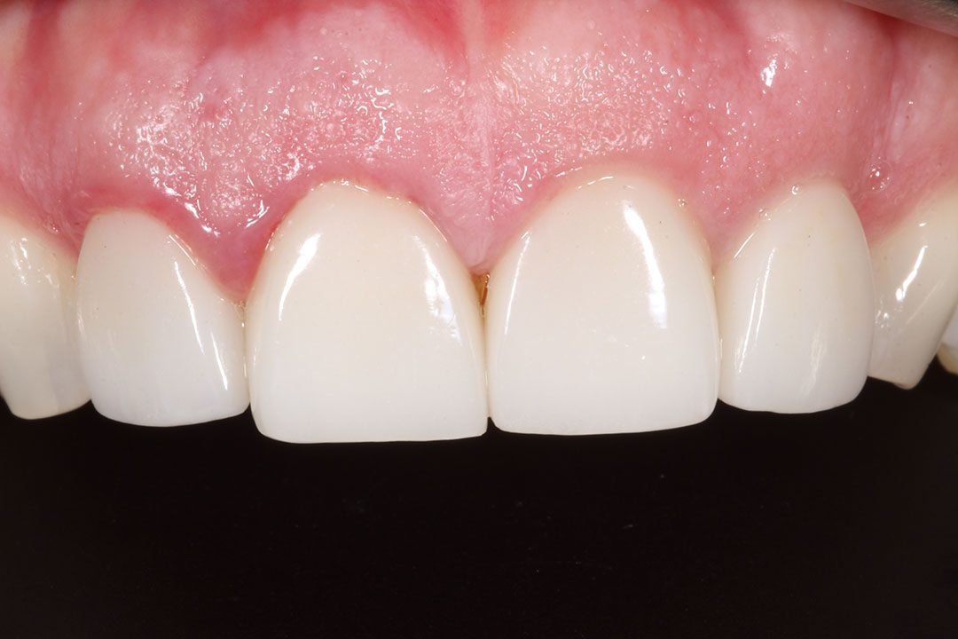 Having a Dental Implant for a Front Tooth - Without Leaving a Gap - Dr ...
